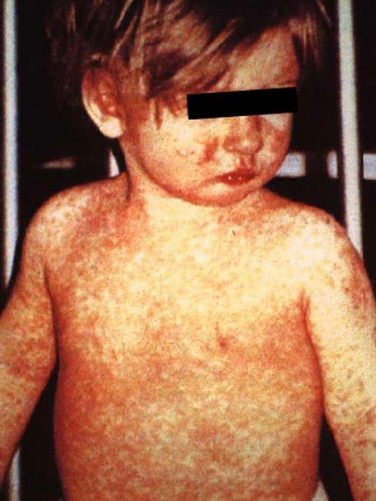 Mom We Weren t willy nilly Exposing People To Measles mom-we-weren-t-willy-nilly-exposing-people-to-measles