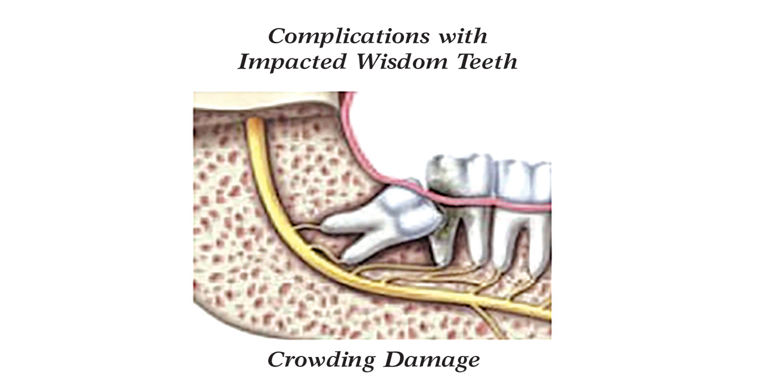 Get wise about wisdom teeth