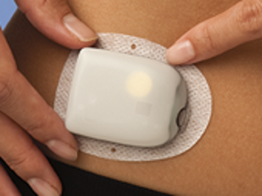 The first ‘artificial pancreas’ systems are coming to market