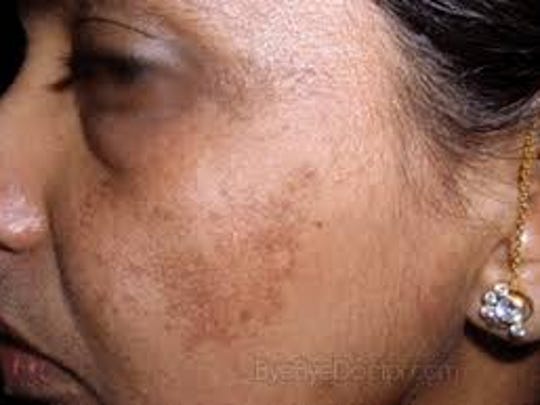 Melasma darkens summer
