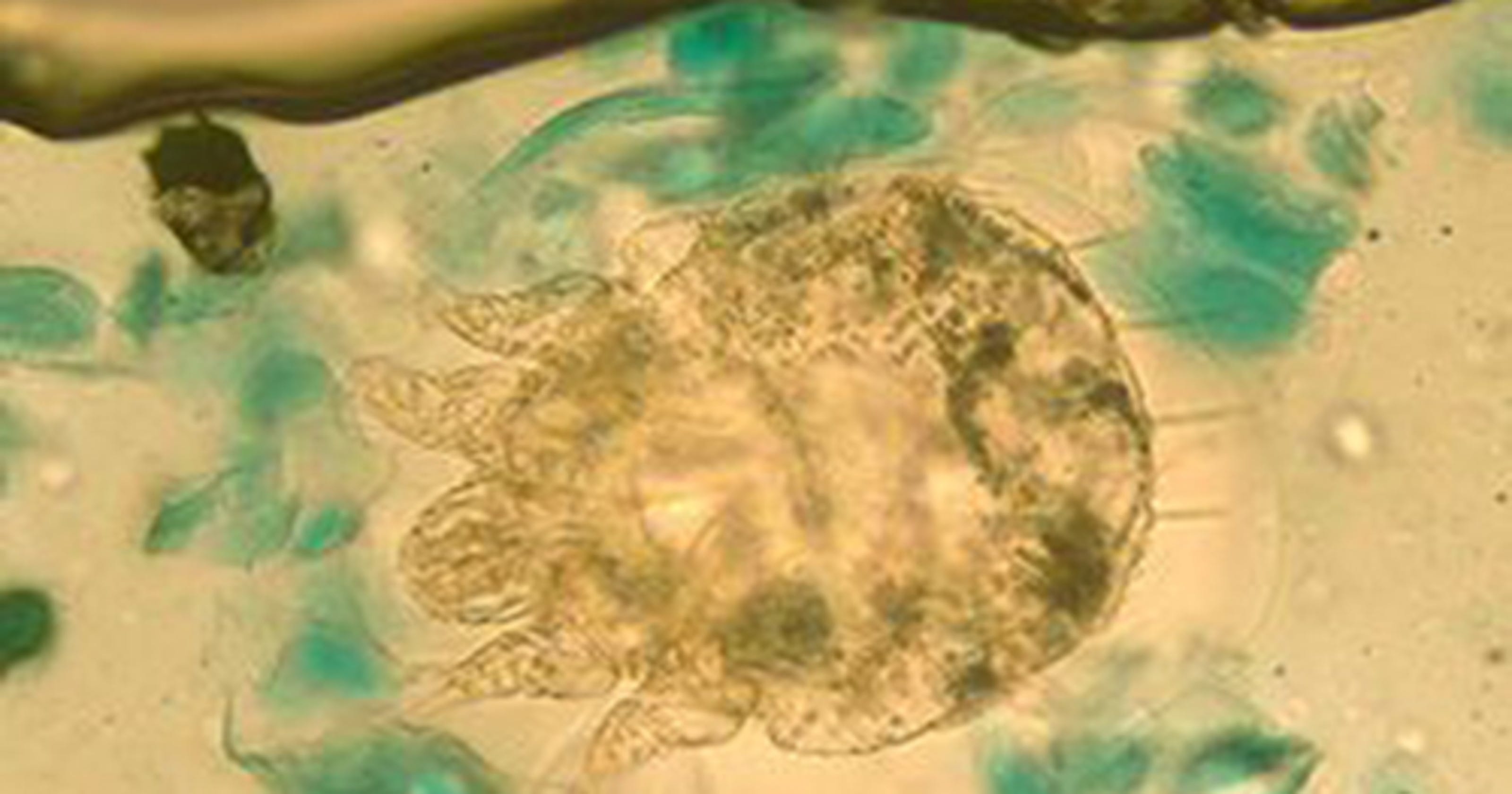 Scabies outbreak reported at Lakewood nursing home