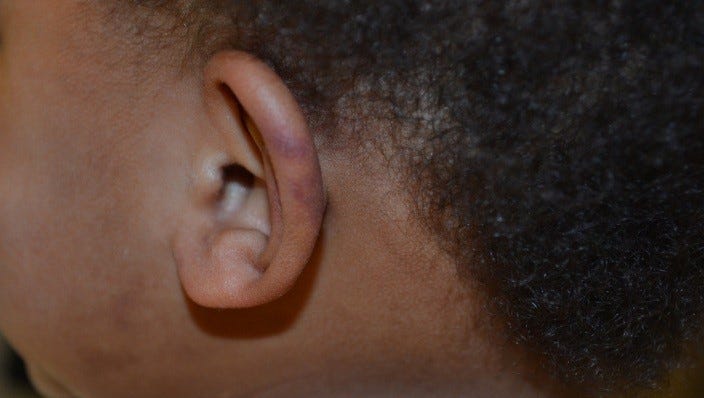 These small injuries are key to catching child abuse