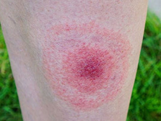 Reducing your risk of Lyme disease as the threat increases