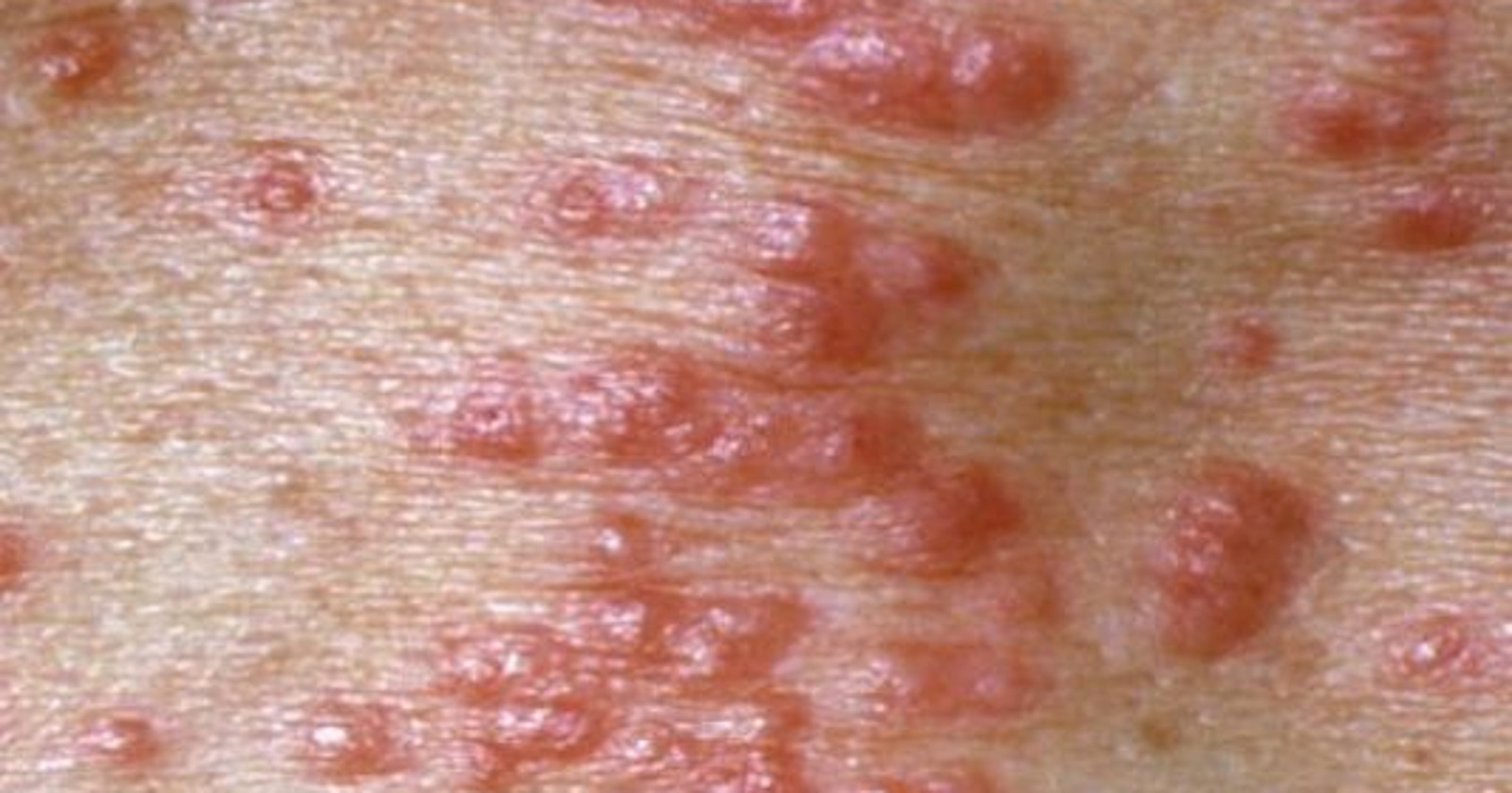 No new scabies cases in Madison, Canton schools this week