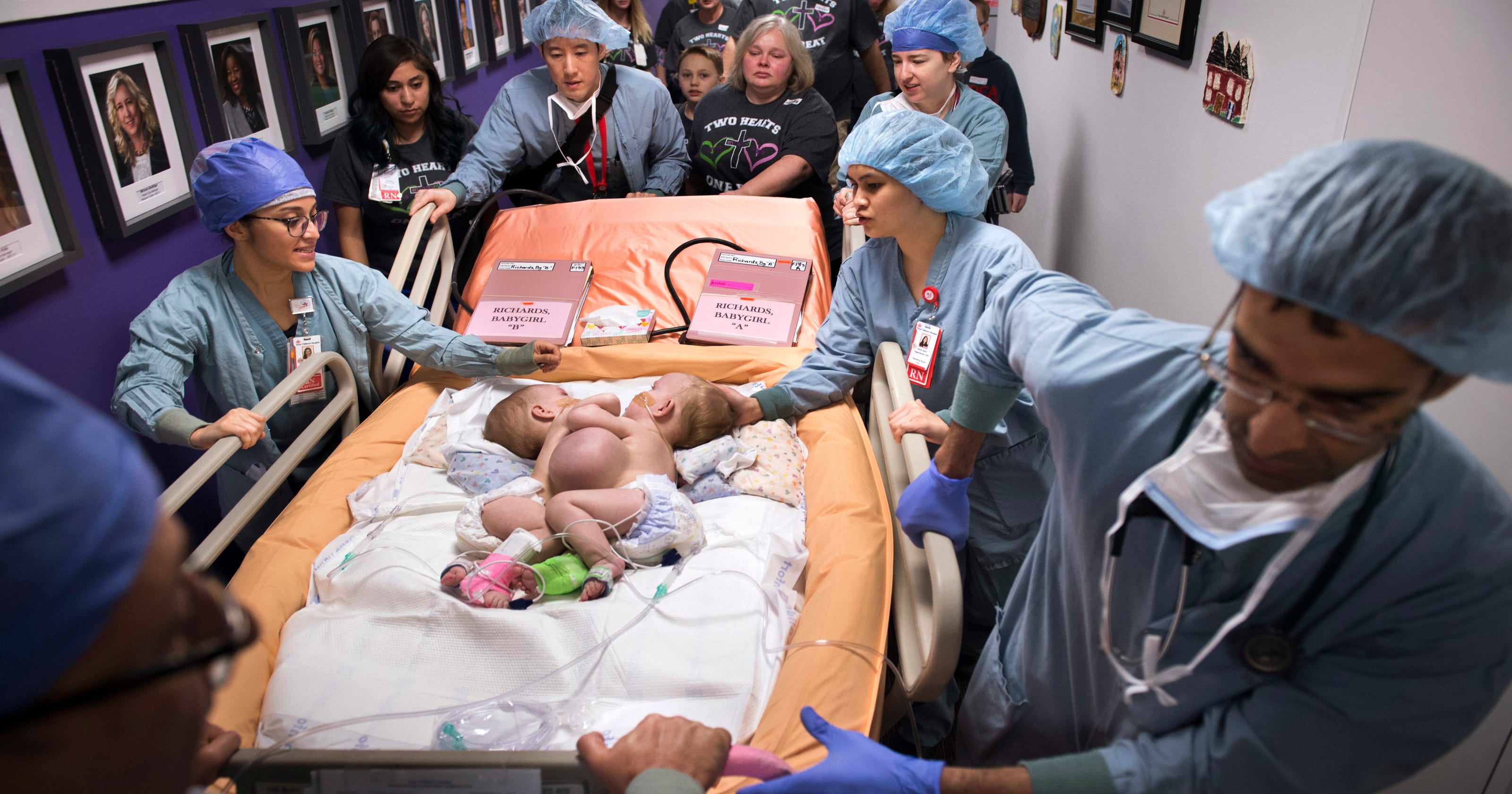 Conjoined twin girls separated by surgeons at Houston hospital