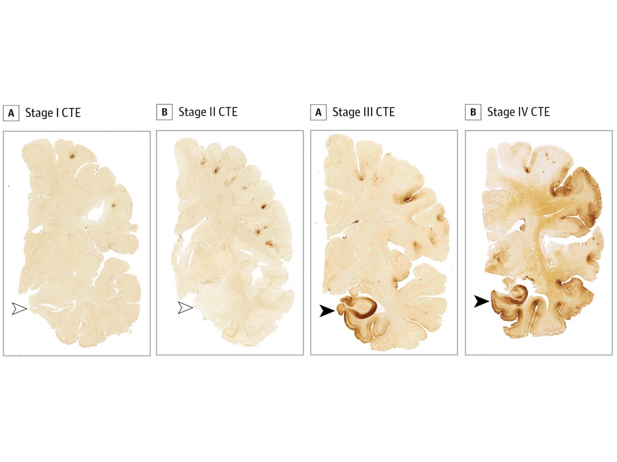 Wisconsin Badgers players downplay concussion risks while evidence piles up
