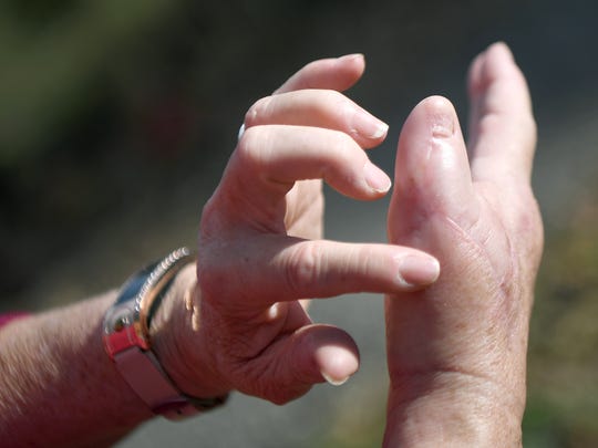 Big toe replaces cancerous thumb in life-changing surgery