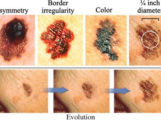 Melanoma skin cancer patients don’t regularly perform thorough skin ...