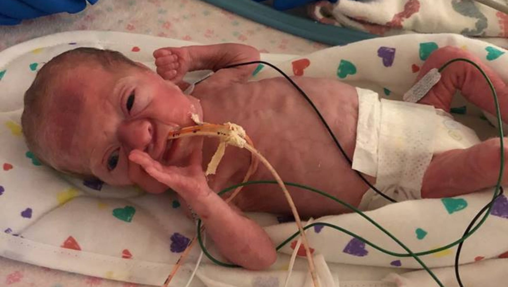 Mom Who Gave Birth To 1 Pound Baby Gets To Hold Her For First Time mom-who-gave-birth-to-1-pound-baby-gets-to-hold-her-for-first-time