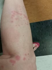 Kissing bugs pucker up in Redding, but disease rare