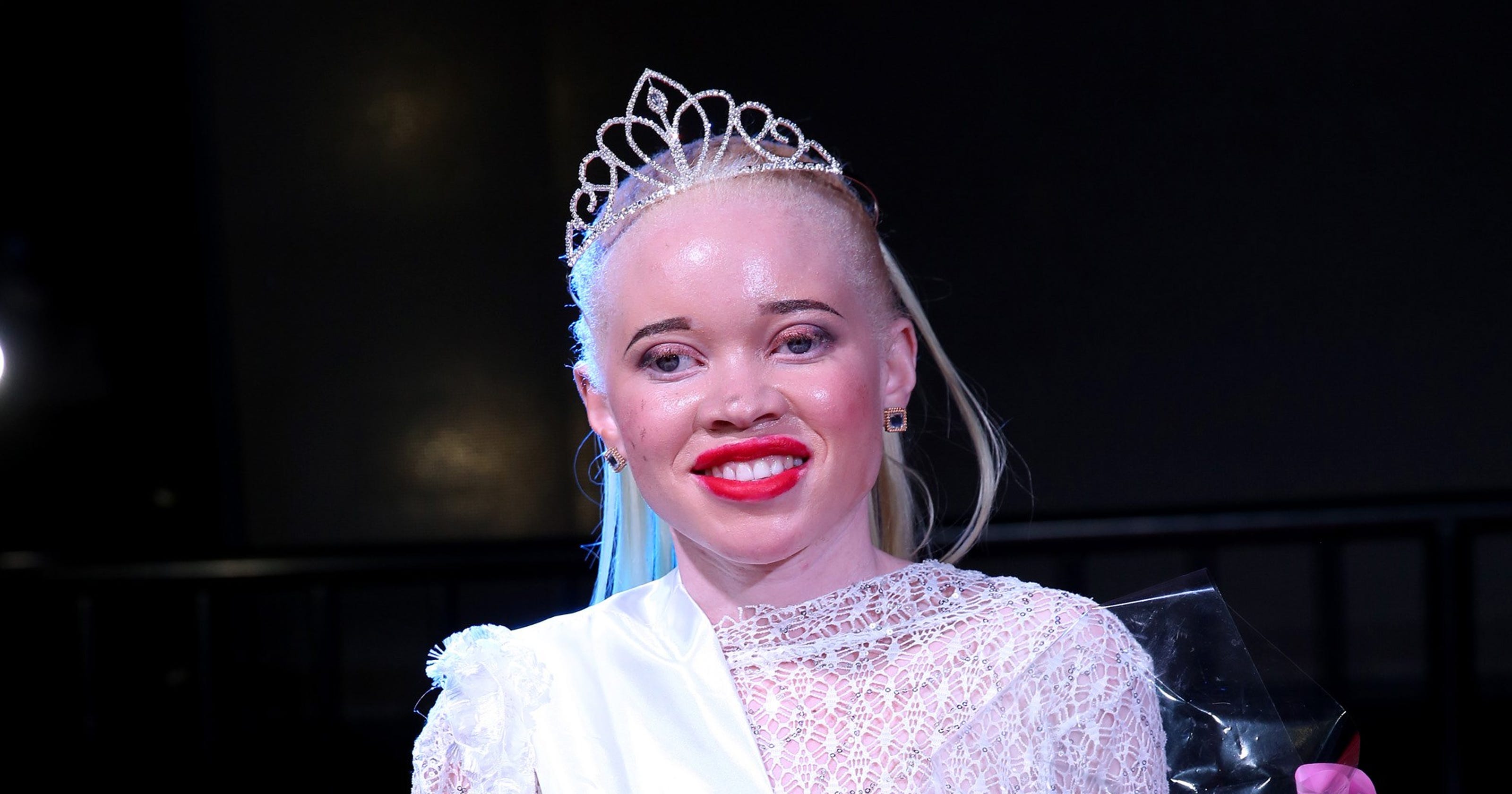 Miss Albino: Zimbabwe crowns first winner in bid to tackle stigma