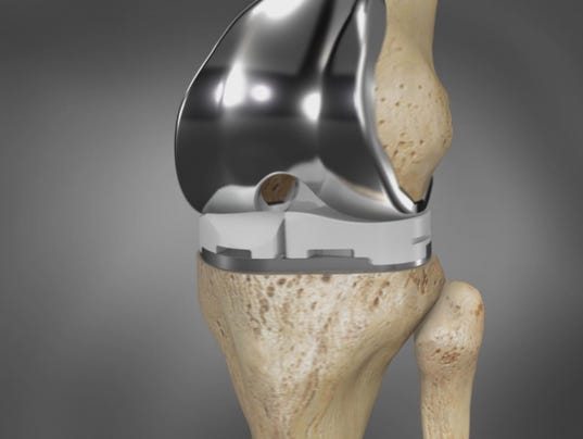 A look at custom knee implants