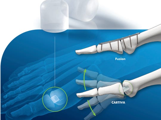 Synthetic cartilage now an option for arthritis