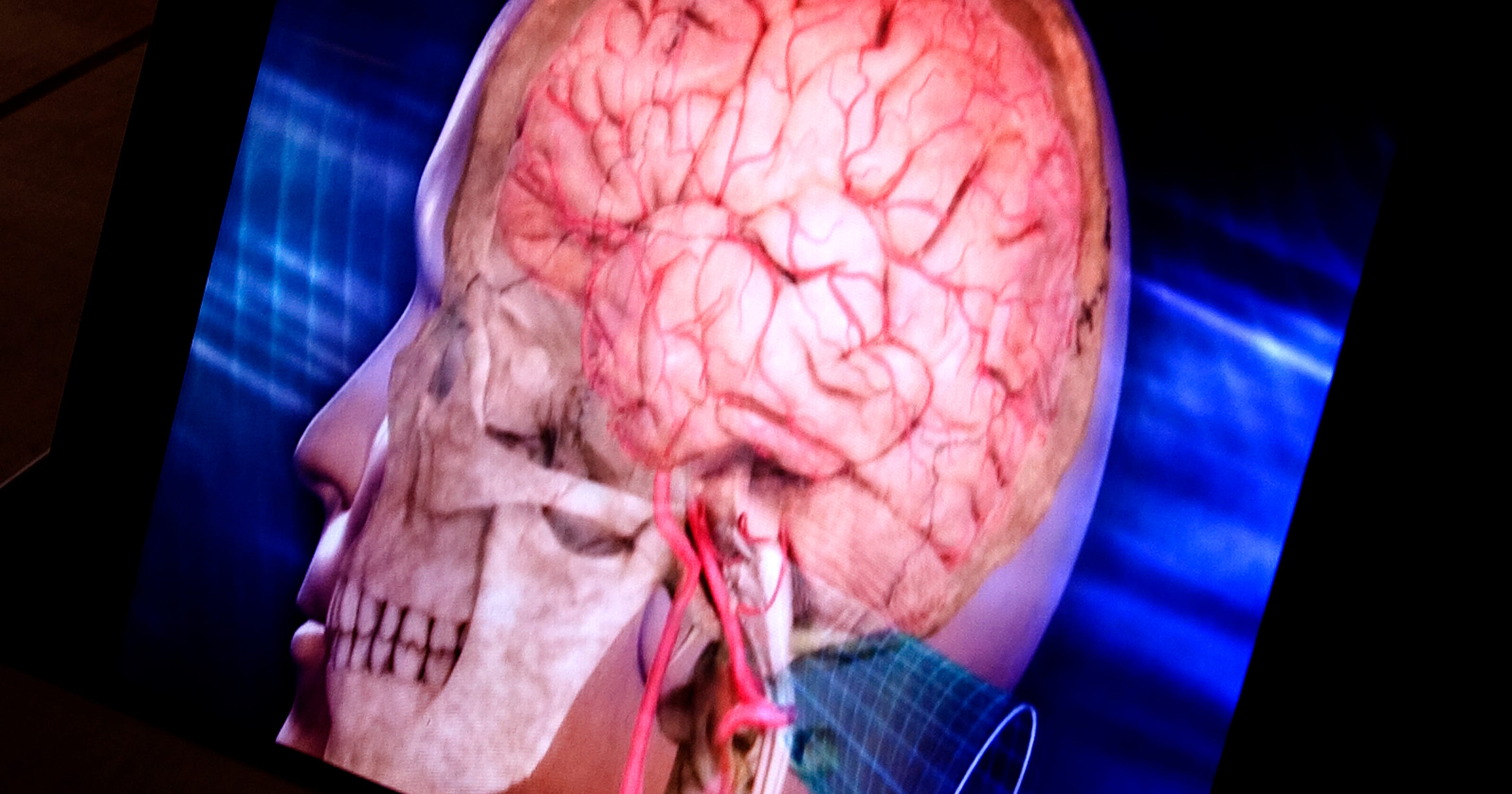 The concussion too many women ignore