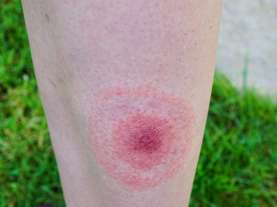 Ticks: What you need to know