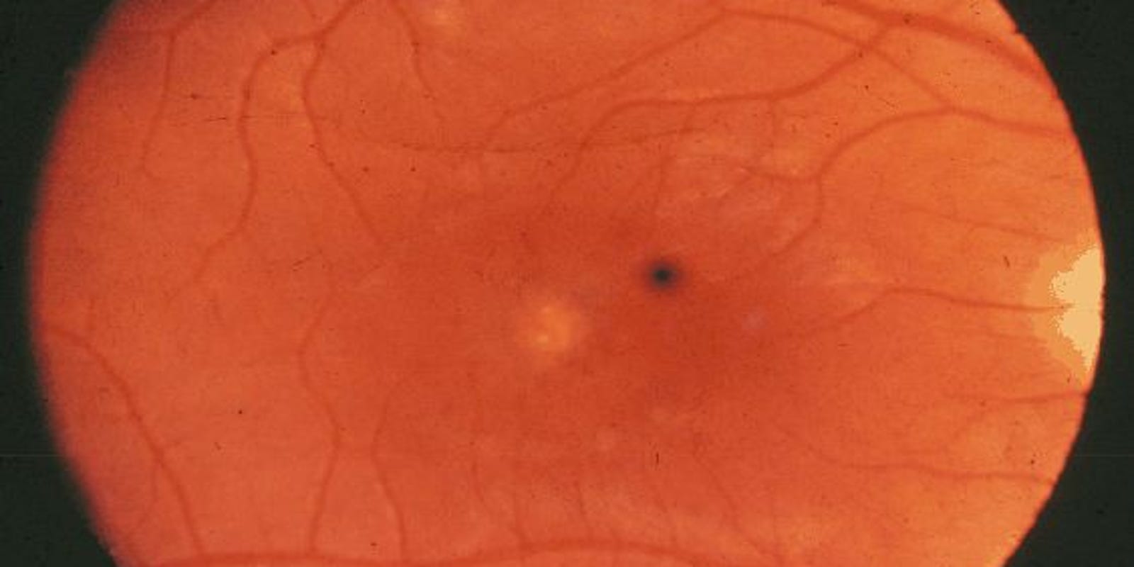 During solar eclipse, protect your eyes. We're not kidding.