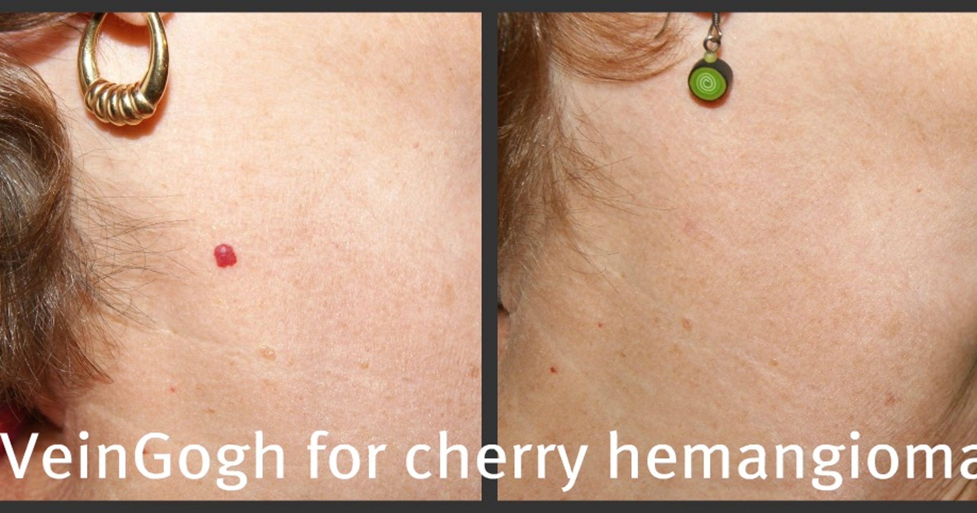 VeinGogh treatment can benefit damaged facial skin