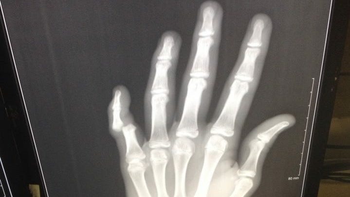 Top QB recruit snaps brother's finger with pass