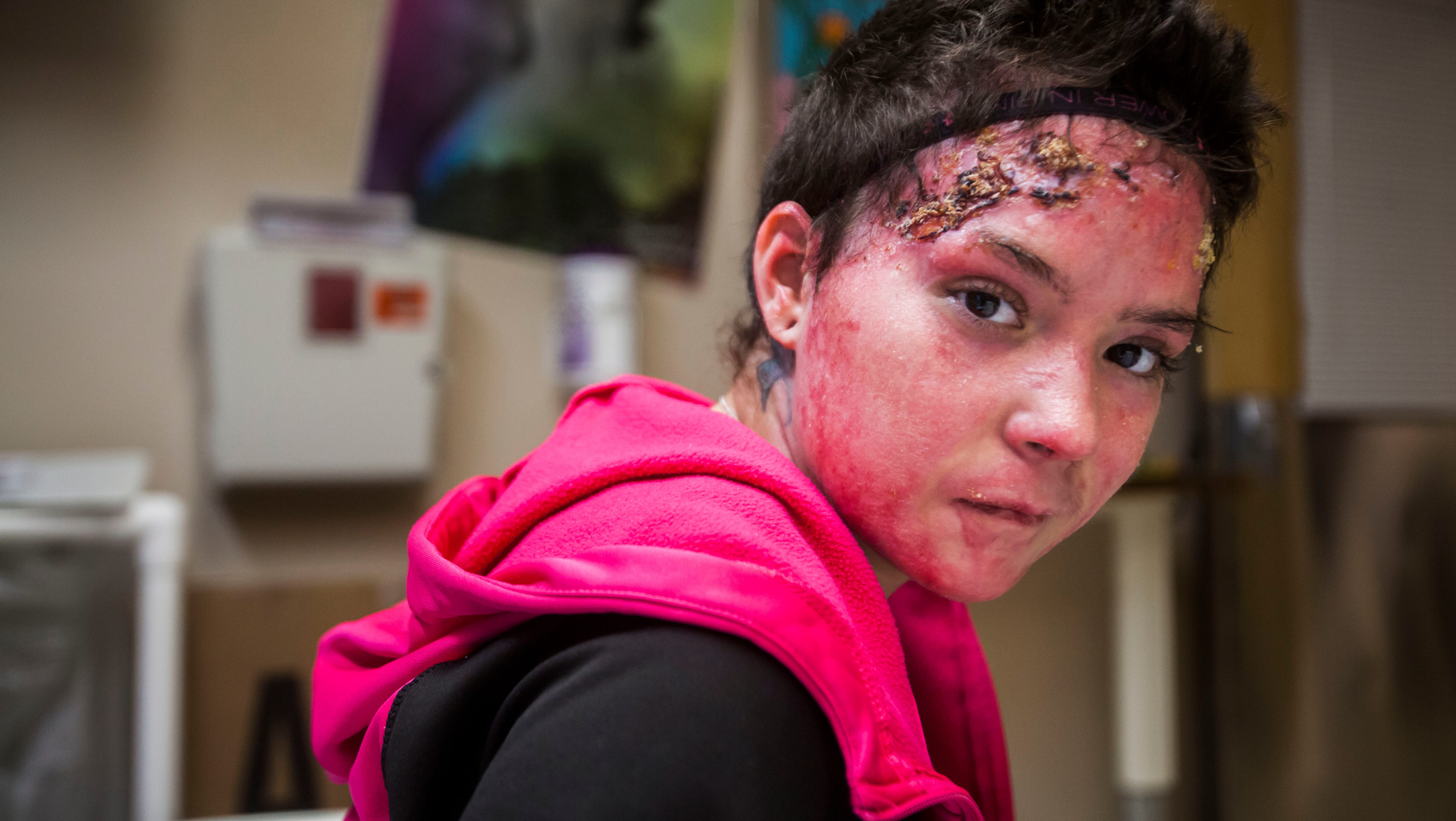 3rd Degree Burn Victims