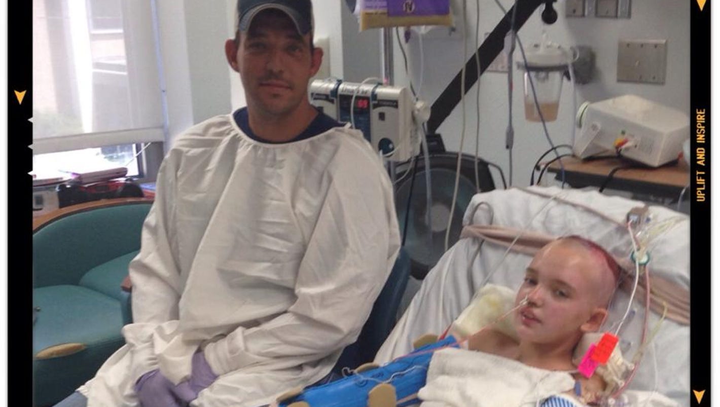 Burn victim: Losing hair is the worst part