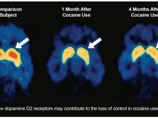 Why some use drugs, steal: How addiction works