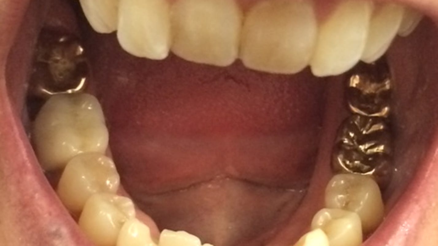 Answer Man: Can gold teeth be pulled before cremation?