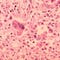 Ohio measles outbreak largest in USA since 1996