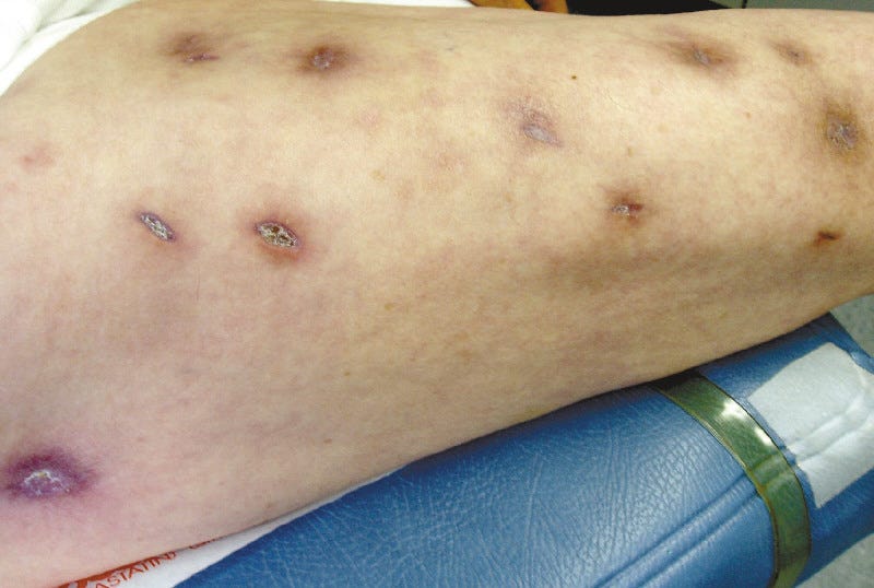 Body Modification Infections