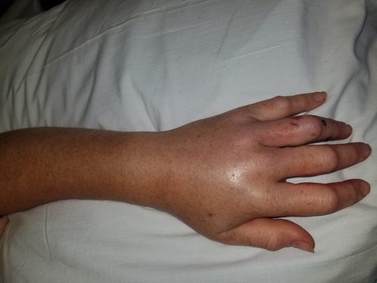 Venomous snake bites on the rise in the Upstate