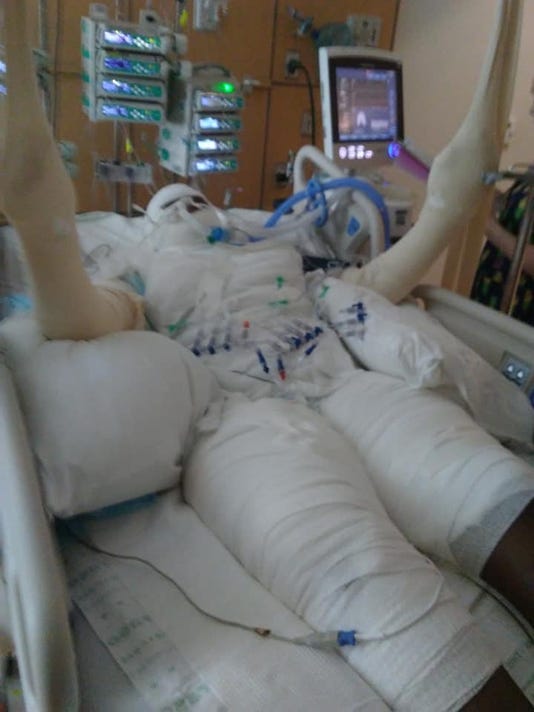 'Fire challenge' girl burned on half her body