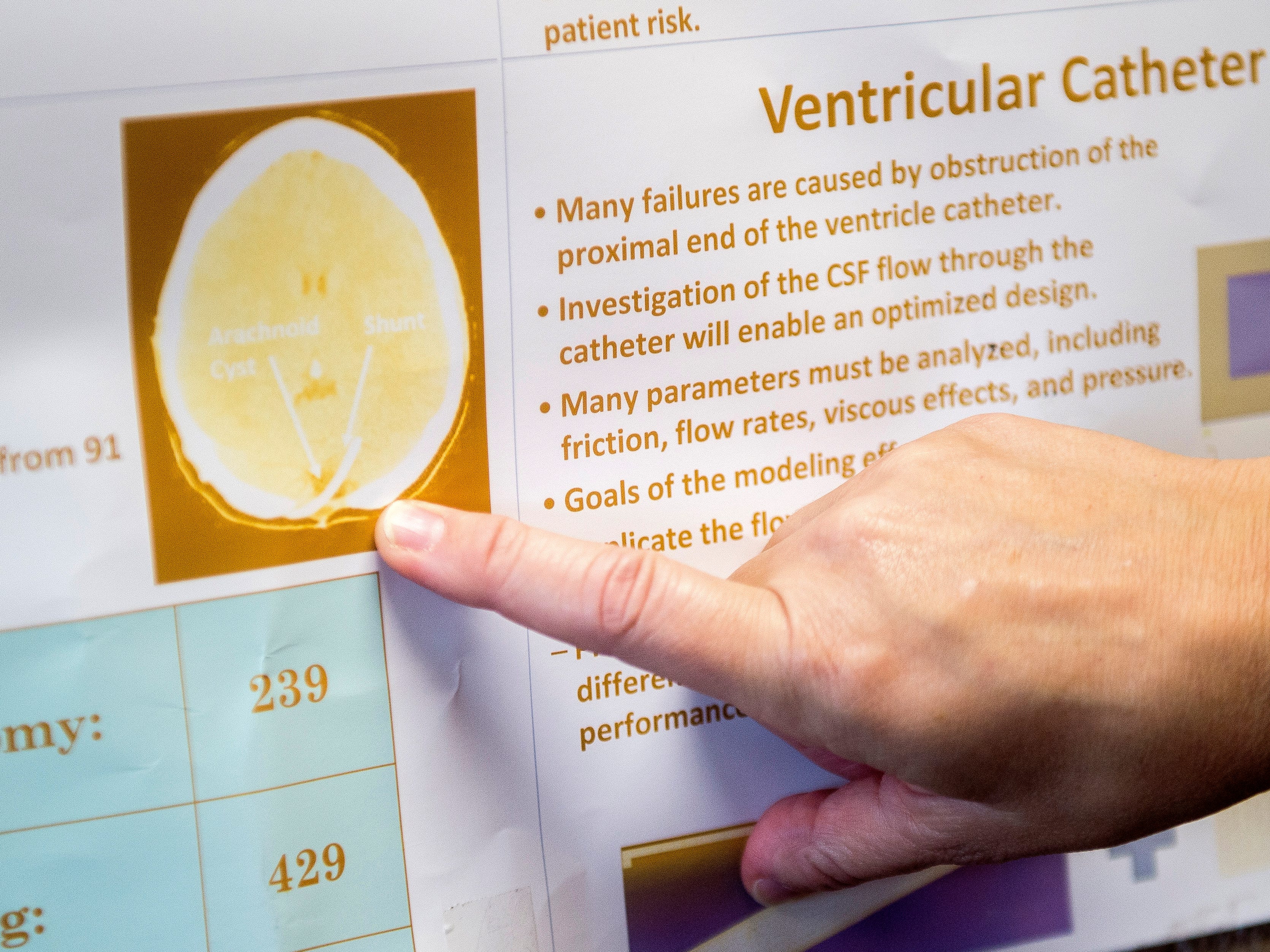 Building a better brain shunt: Research is personal for UT professor ...