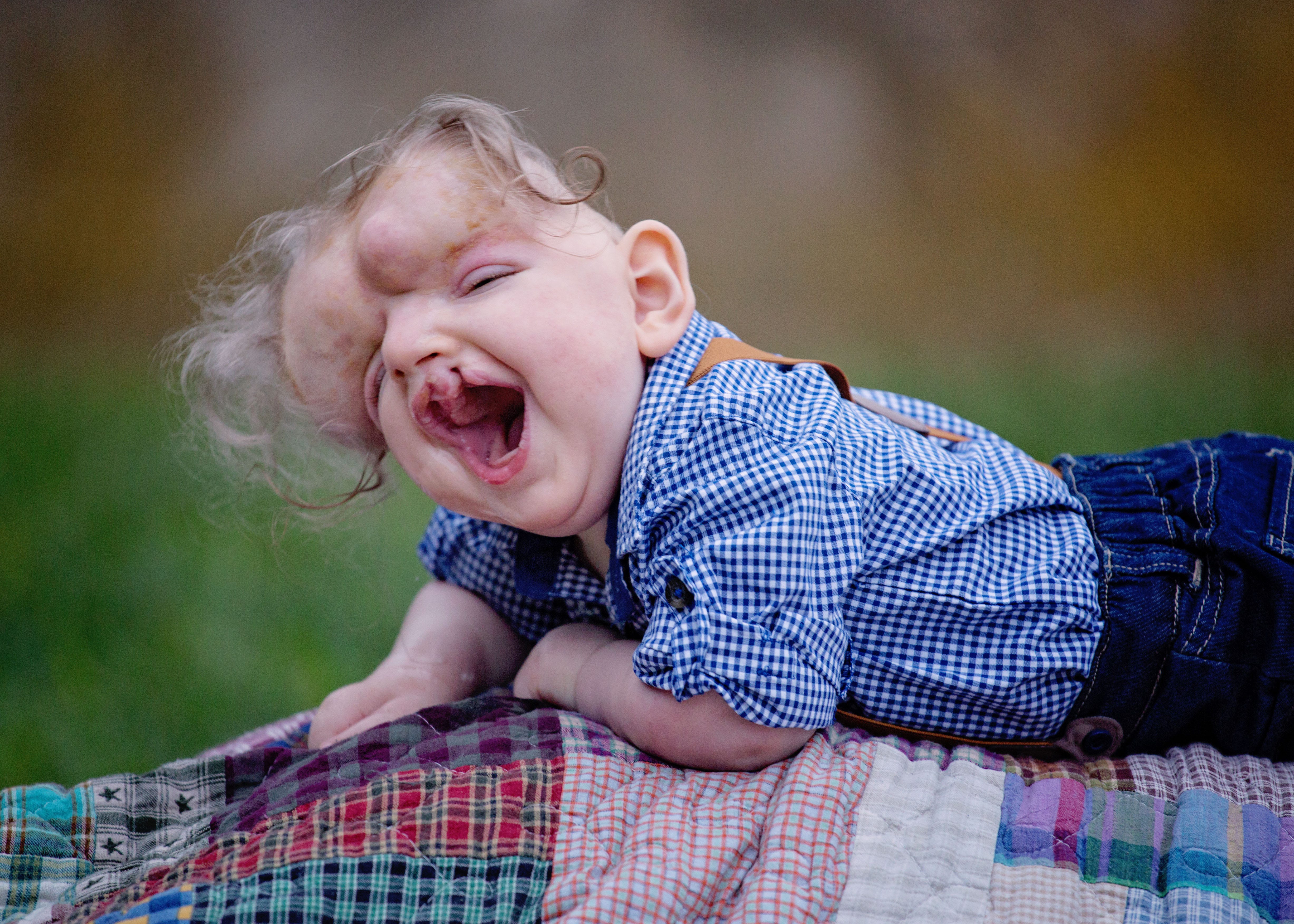 Baby Born Without Head