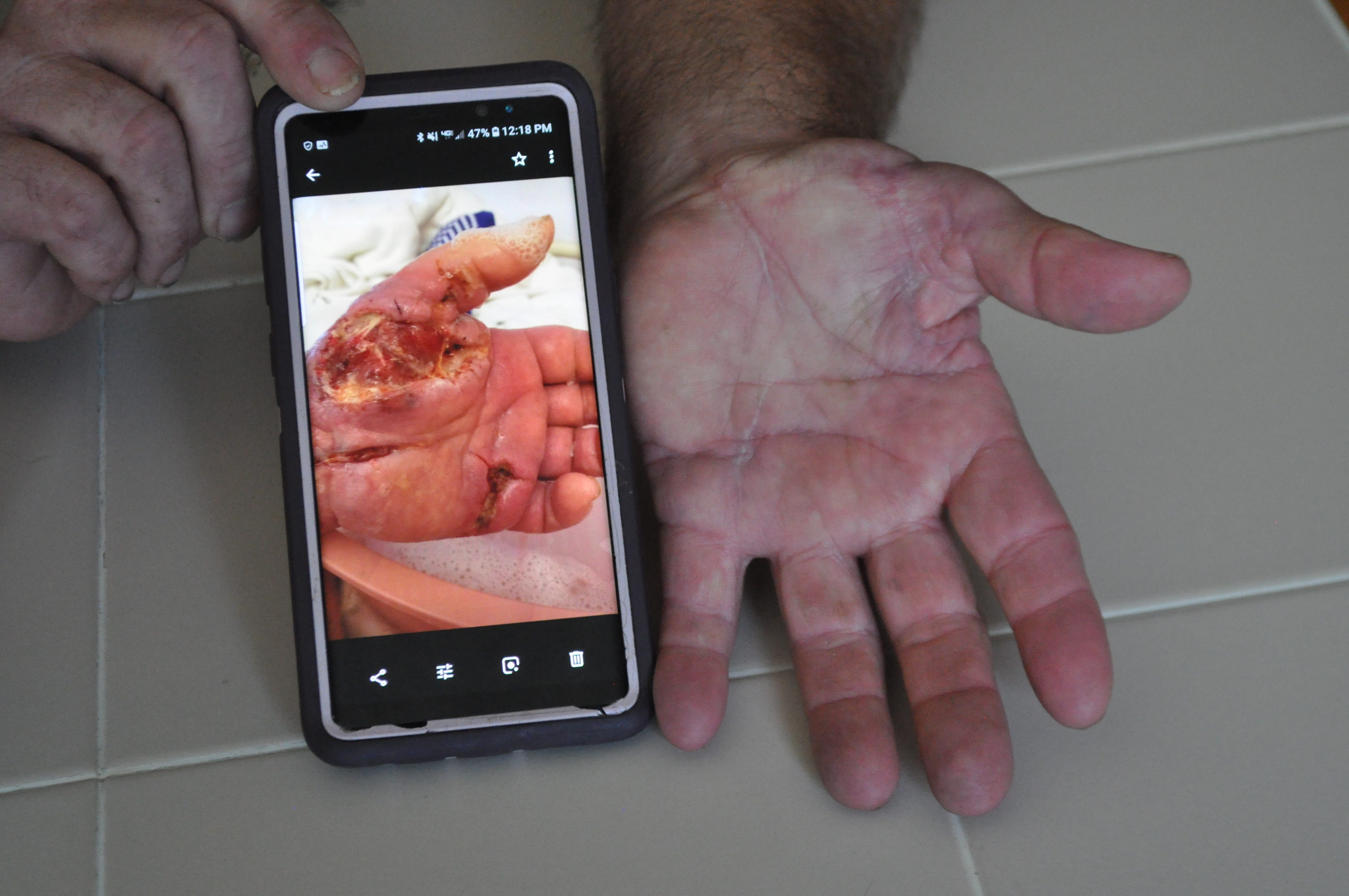 'Flesh-eating bacteria' case: Meet man who survived Vibrio vulnificus