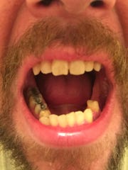 Meth seizures total more than heroin. Its effect on victims is brutal