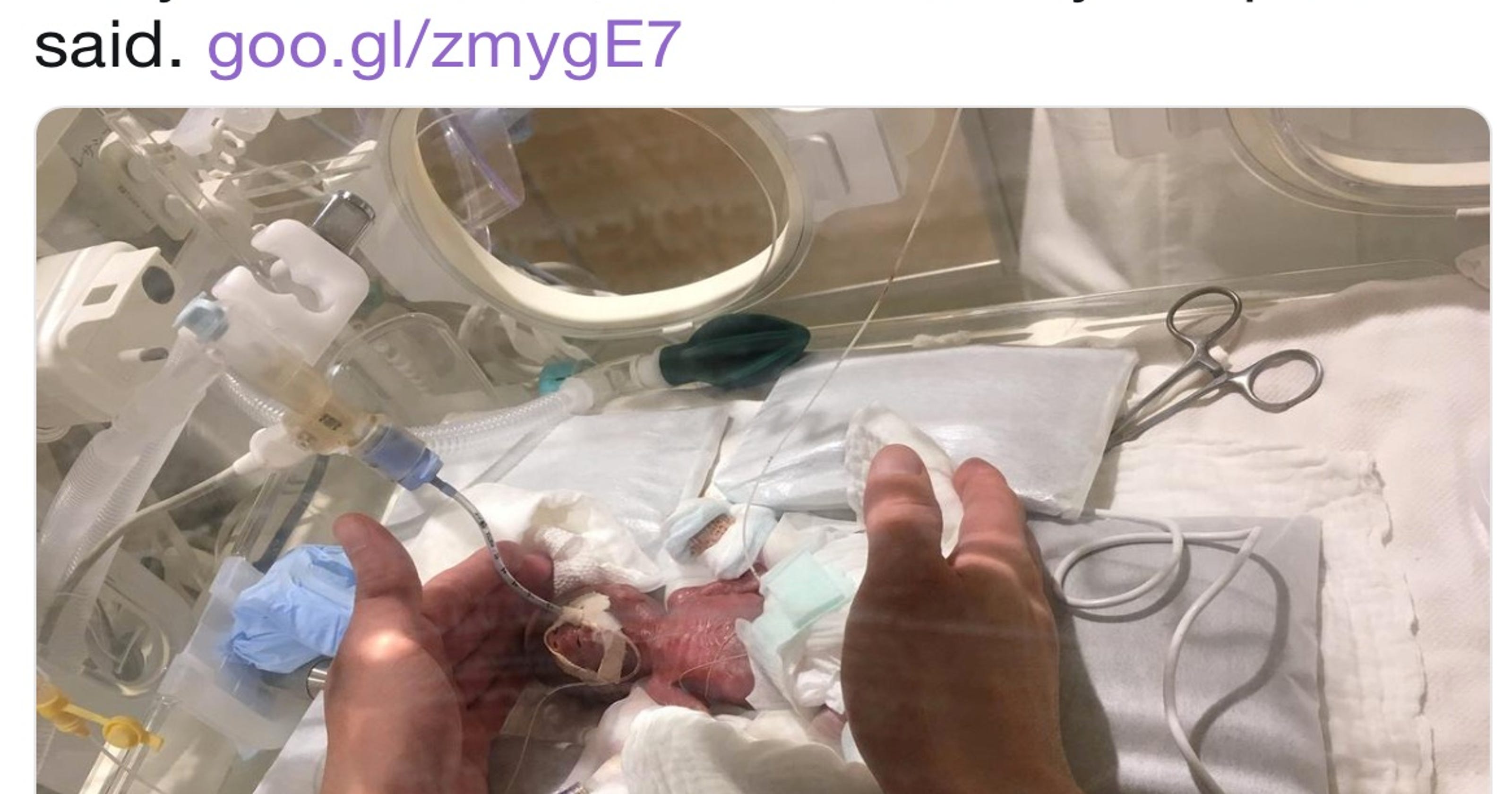 World's tiniest baby boy weighed less than 10 ounces at birth in Japan