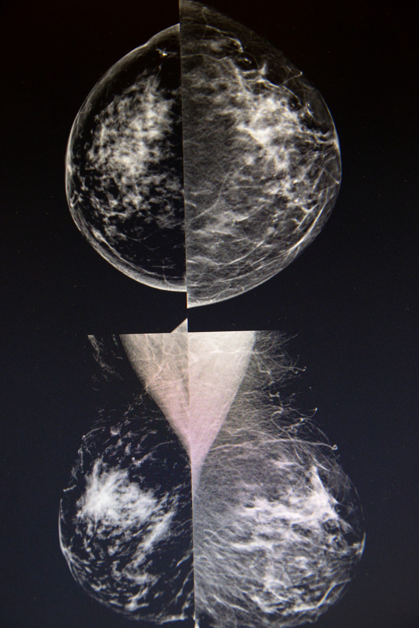 What you need to know before choosing a 2D or 3D mammogram