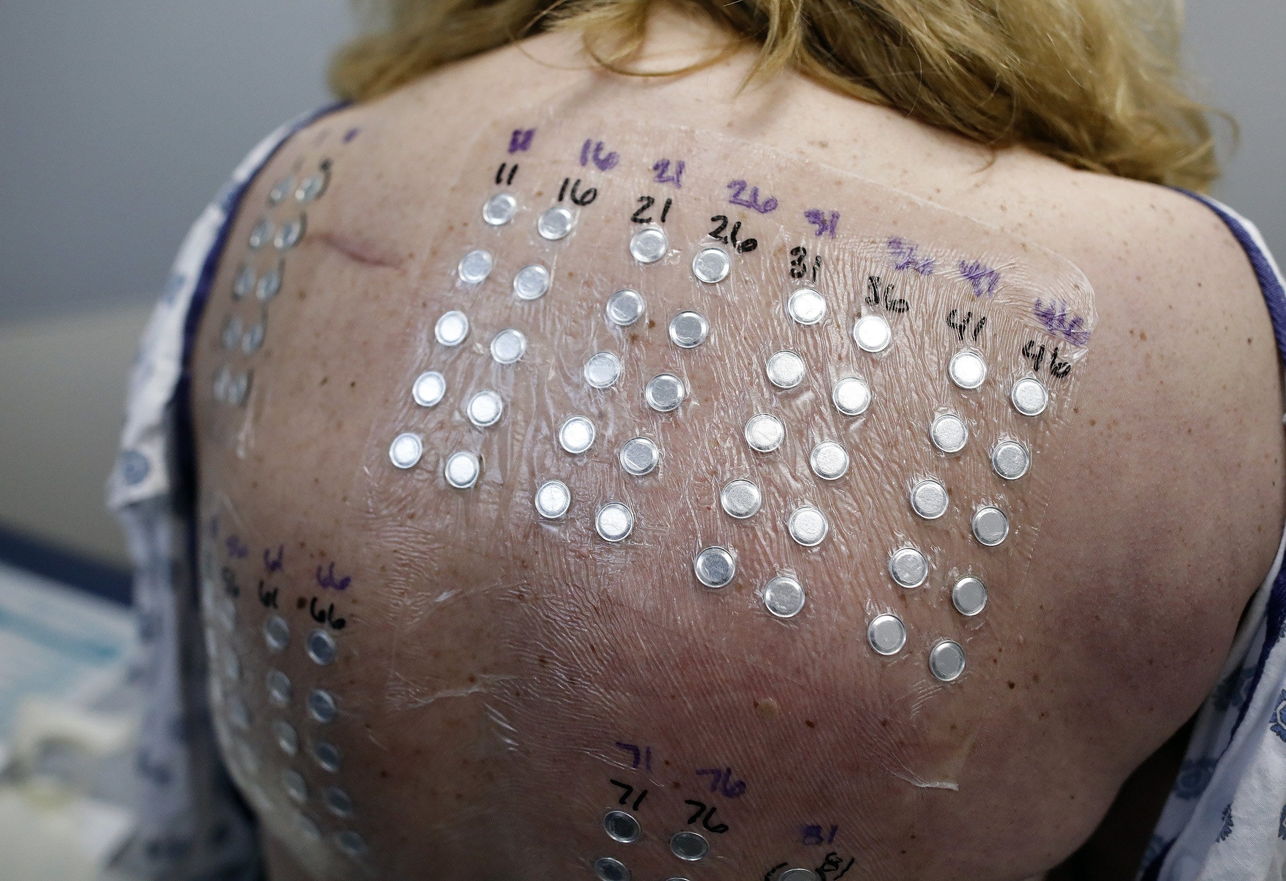 More than 1 million Ohioans may be allergic to metals