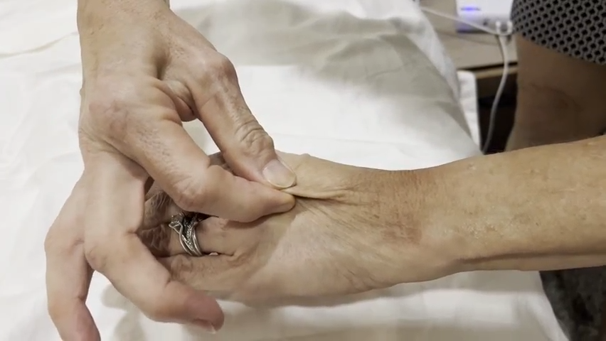 Fact check: Experts say pinch test on hand can measure hydration