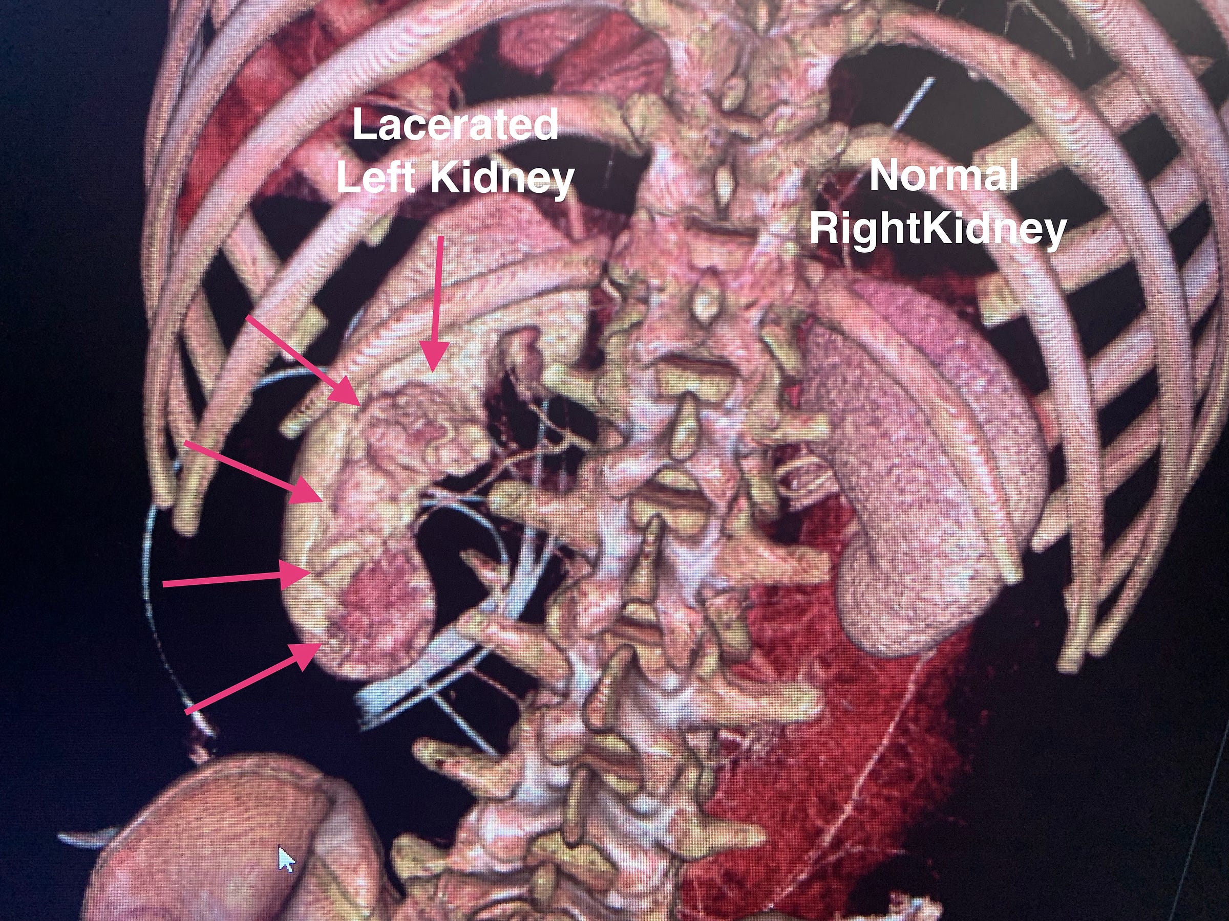 A Wisconsin football player lacerated his kidney. How he came back.